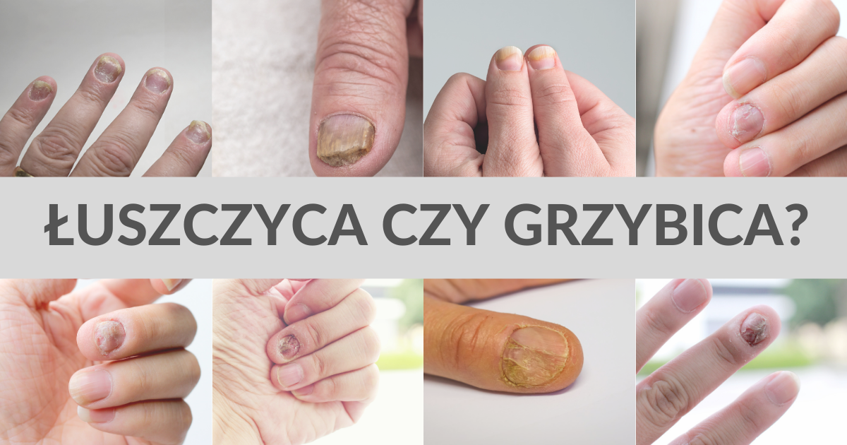 Jak odróżnić grzybicę od łuszczycy paznokci? - Cutis